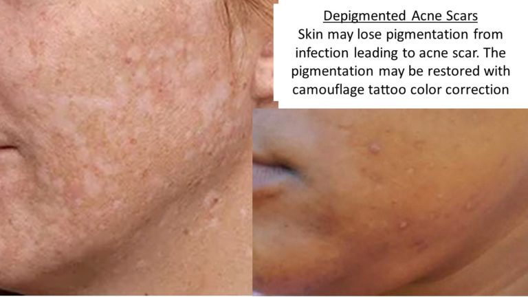Patchy Beard Camouflage Tattoo - Acne Scar Florida