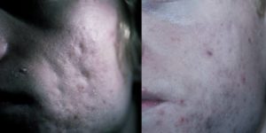 Rolling Scar Rewind Treatment - Subcision & Filler Procedure