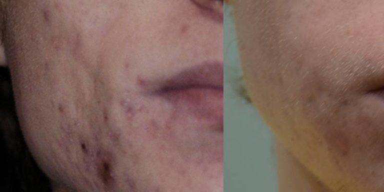 Rolling Scar Rewind Treatment - Subcision & Filler Procedure