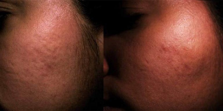 Rolling Scar Rewind Treatment - Subcision & Filler Procedure