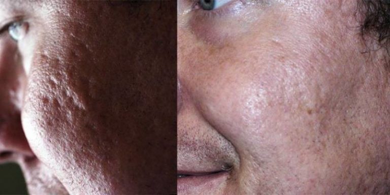 Rolling Scar Rewind Treatment - Subcision & Filler Procedure