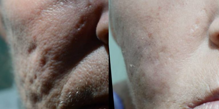 Rolling Scar Rewind Treatment - Subcision & Filler Procedure