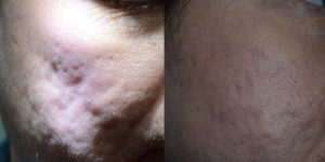 Rolling Scar Rewind Treatment - Subcision & Filler Procedure