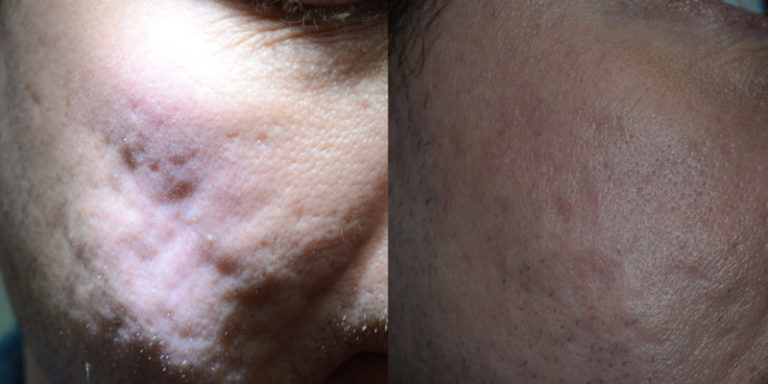 Rolling Scar Rewind Treatment - Subcision & Filler Procedure