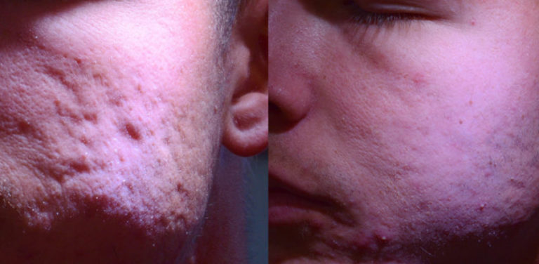 Rolling Scar Rewind Treatment - Subcision & Filler Procedure