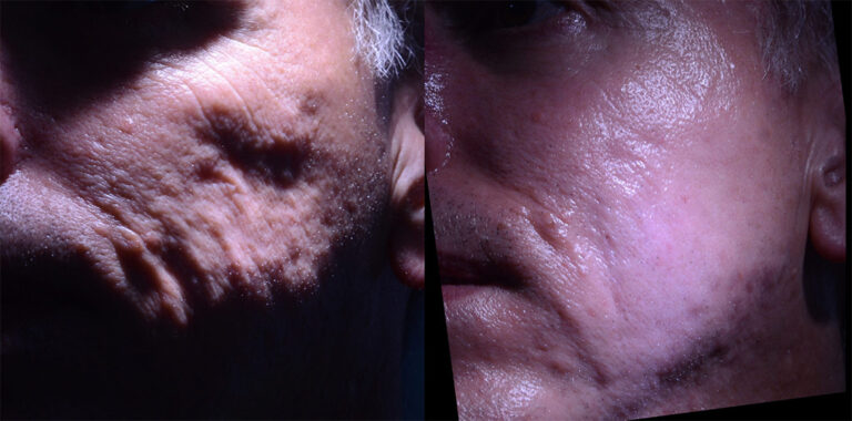 Rolling Scar Rewind Treatment - Subcision & Filler Procedure