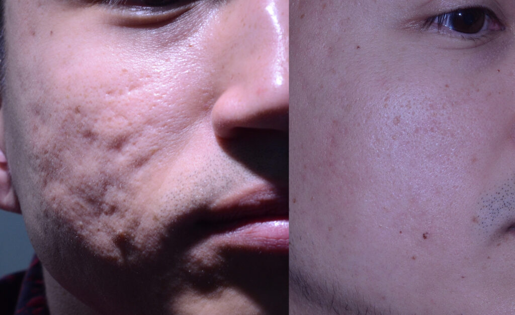 Rolling Scar Rewind Treatment - Subcision & Filler Procedure